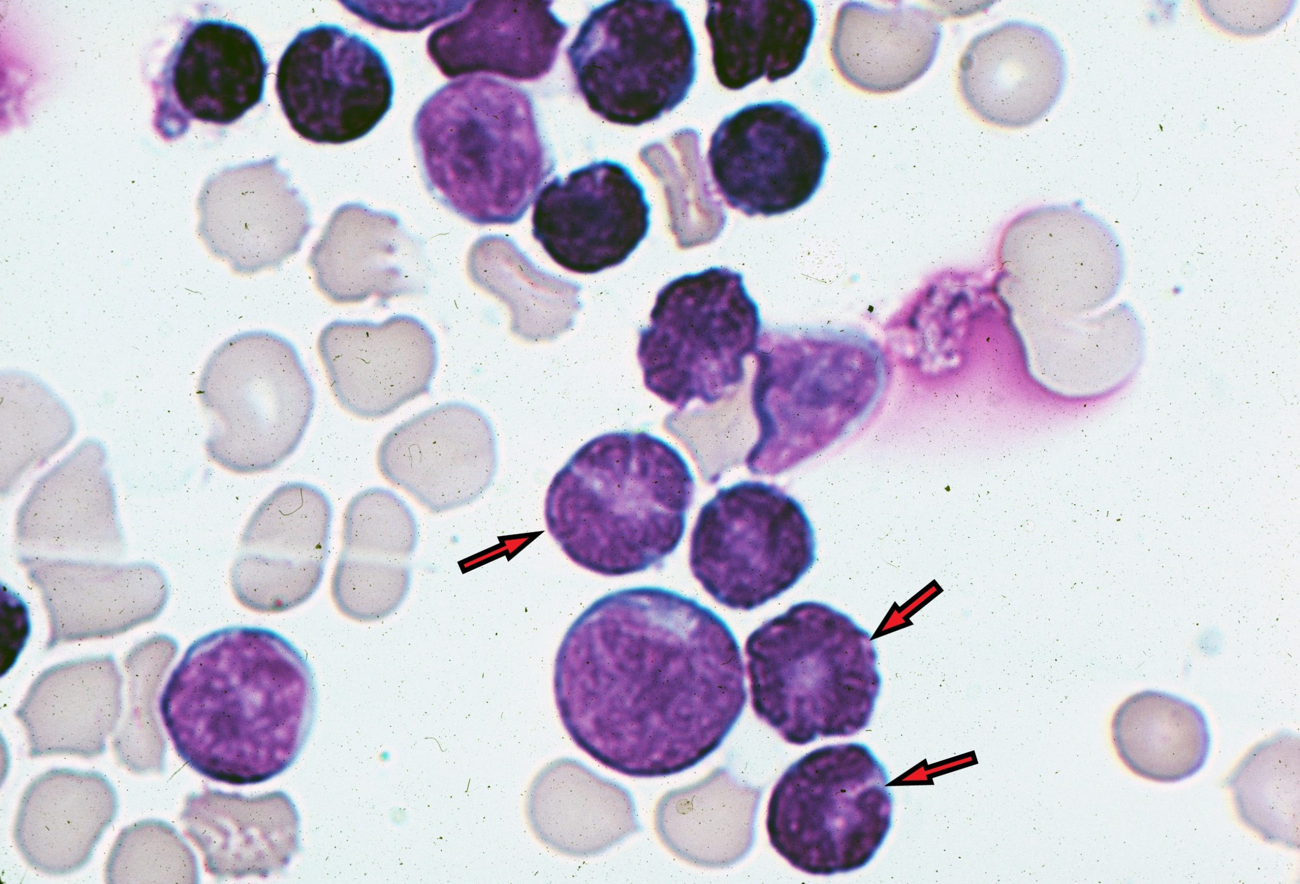 Lymphocytes – Clinical Laboratory Science